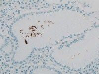 Helicobacter pylori (HP) – Control Dx